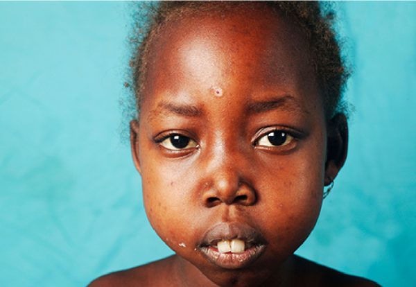Sickle Cell Disease – Know Your Genotype